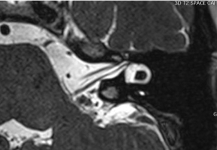 ORL-DPC | (R)évolutions dans la prise en charge des polyposes naso ...