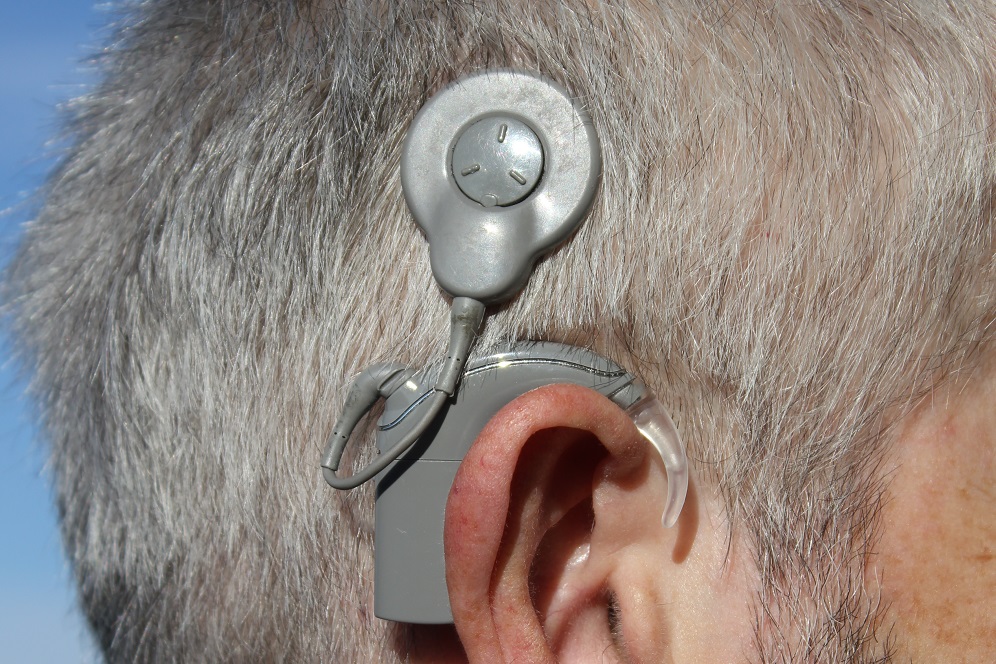 ORL-DPC | Evolutions des indications de l’implant cochléaire chez l ...
